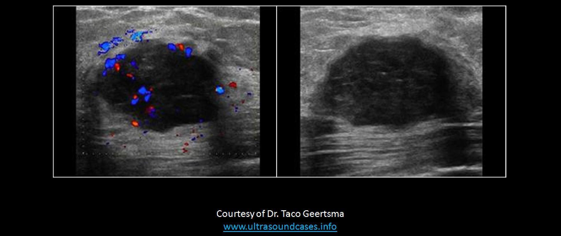 Invasive Ductal Carcinoma Ultrasound Invasive Ductal Carcinoma Ultrasound