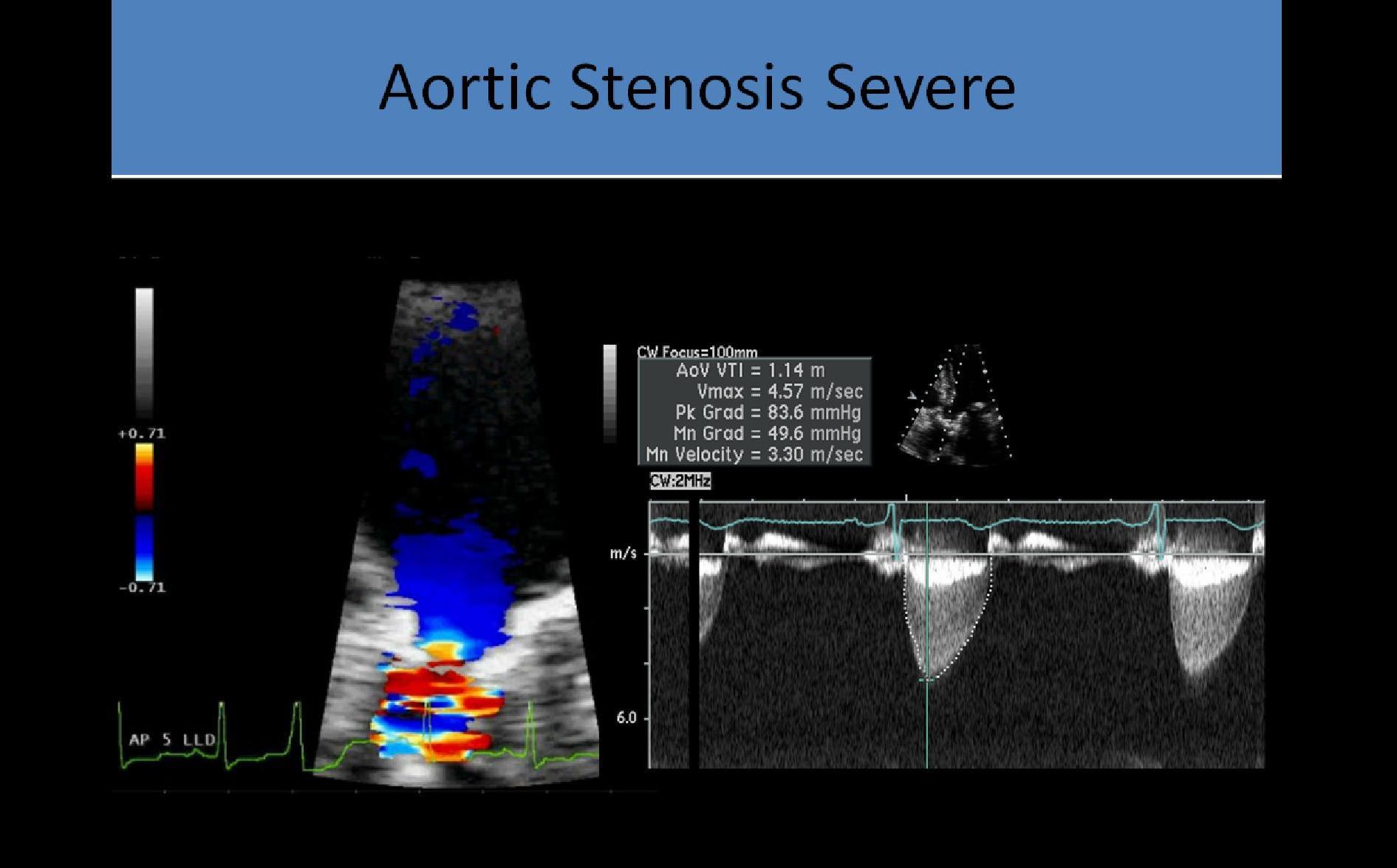 Ultrasound Registry Review Aortic Stenosis Ultrasound Registry Review Aortic Stenosis